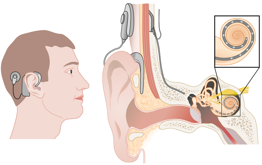 个人化CI外科和听力复健策略